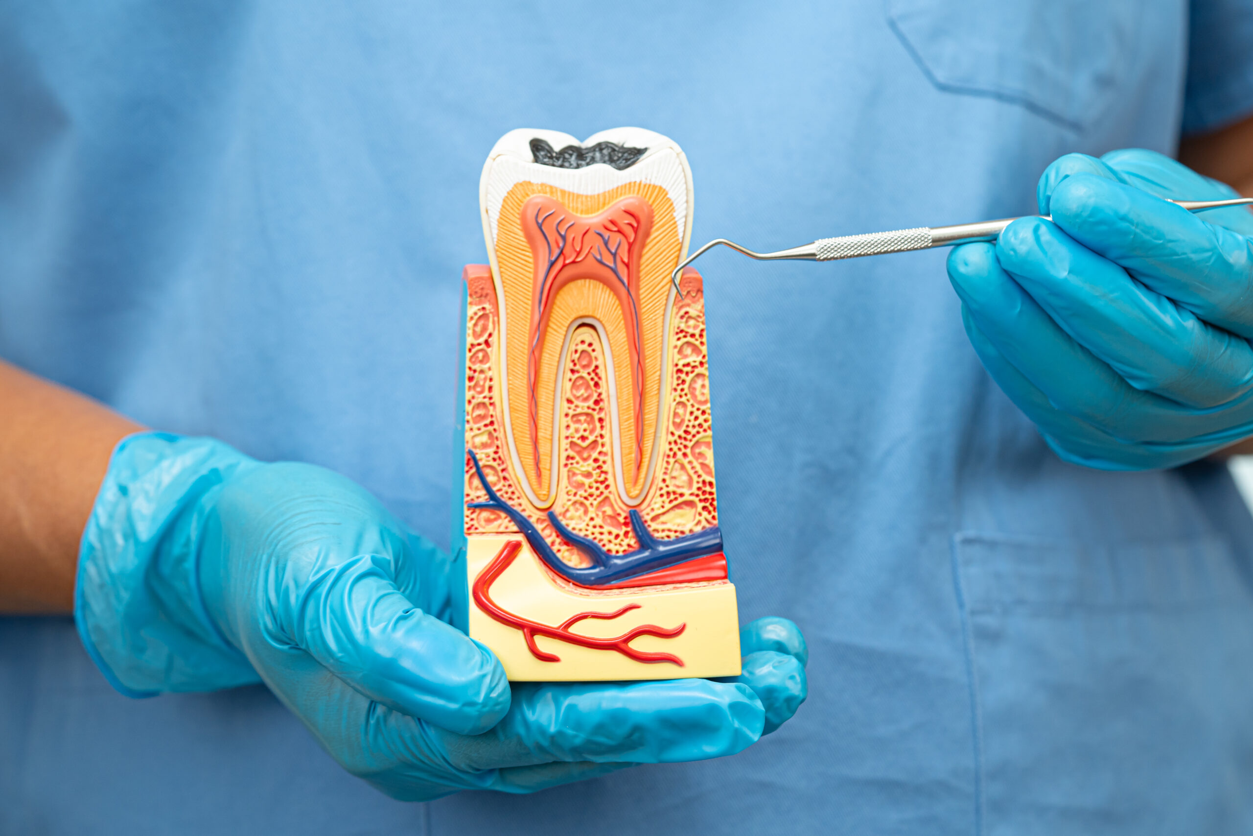 Traitement des Caries à Marlenheim – Soins Conservateurs